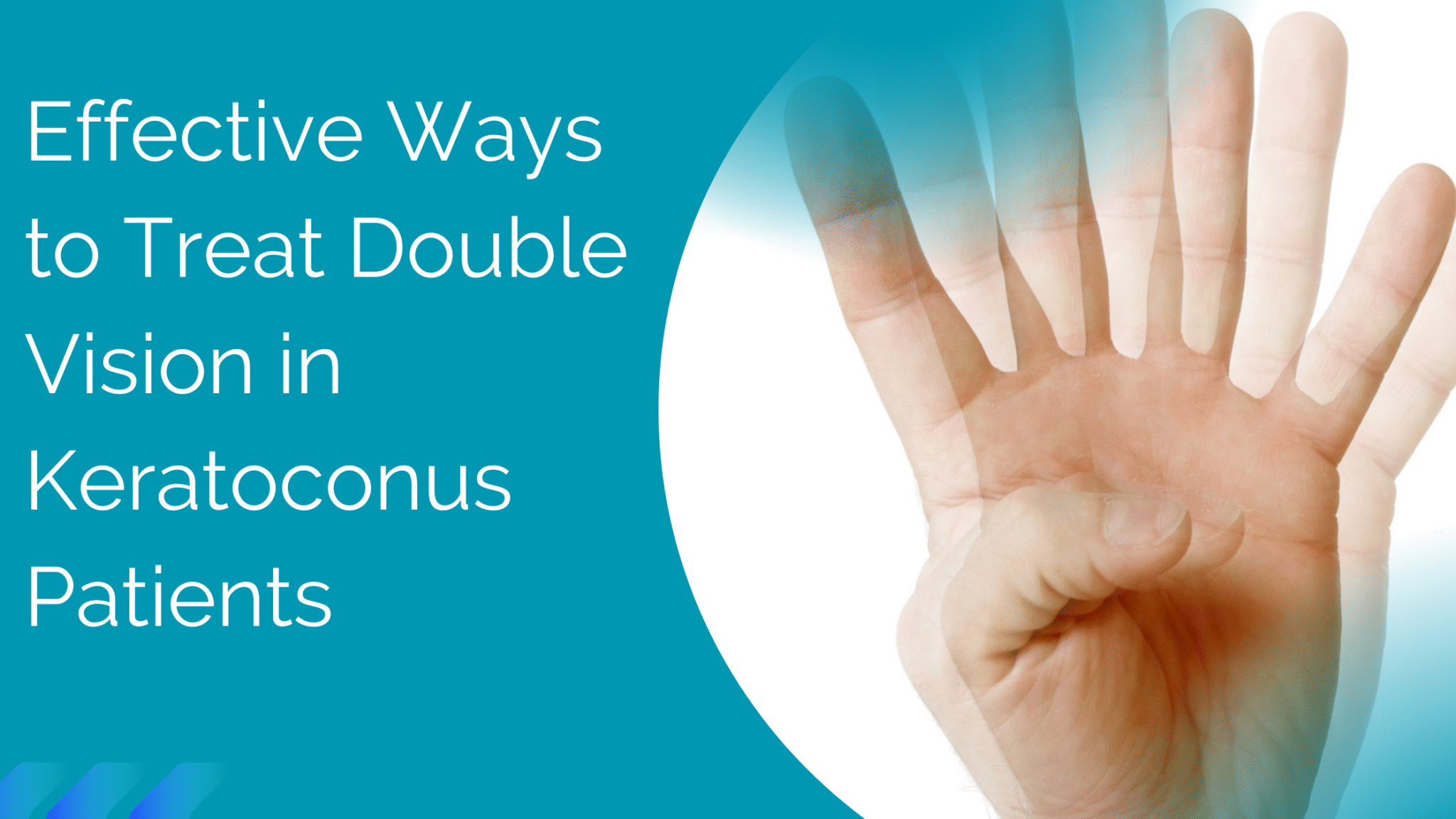Treating Double Vision in Keratoconus Patients | Dr. Vinay Agrawal